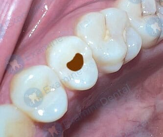G.V. Black’s Classification of Caries - ExamineDental