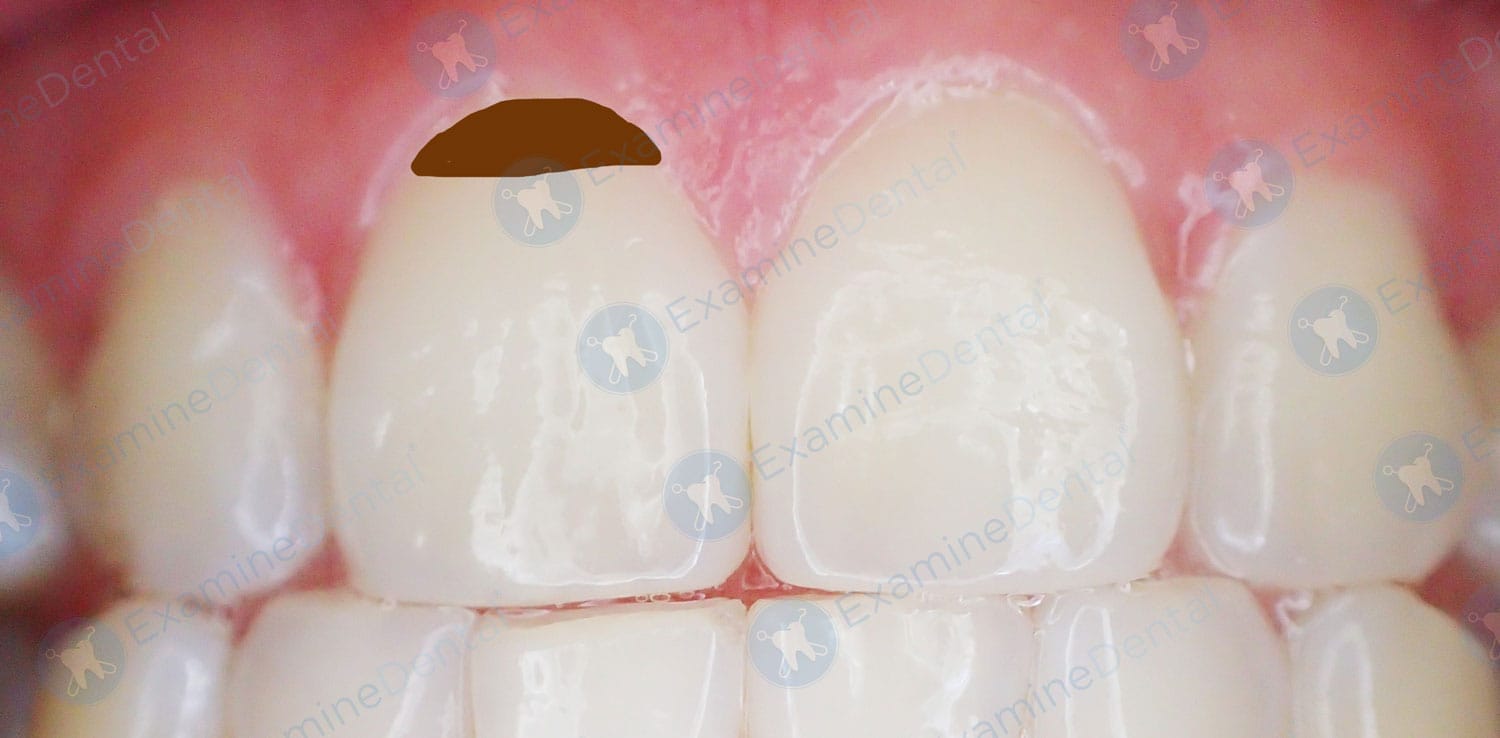 G.V. Black’s Classification of Caries - ExamineDental